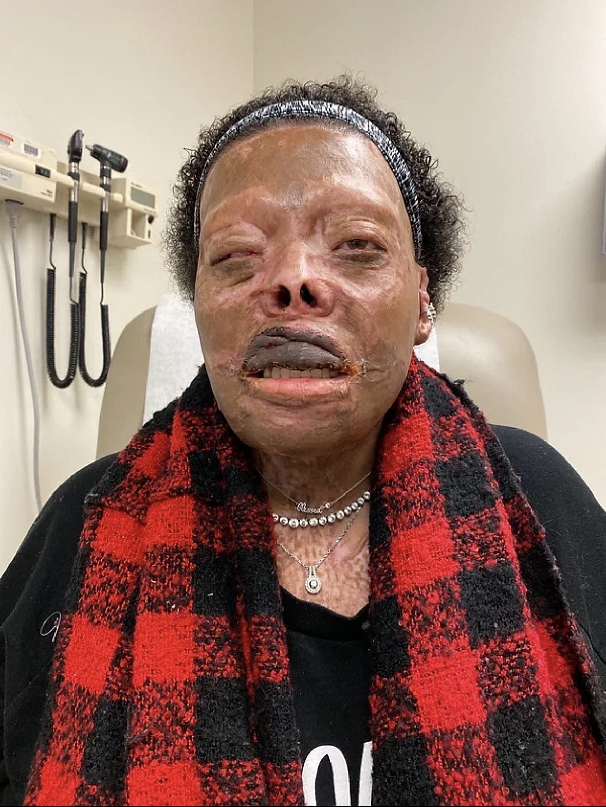 Popular Beauty Influencer Recalls Surviving Being Set On Fire By Her Ex